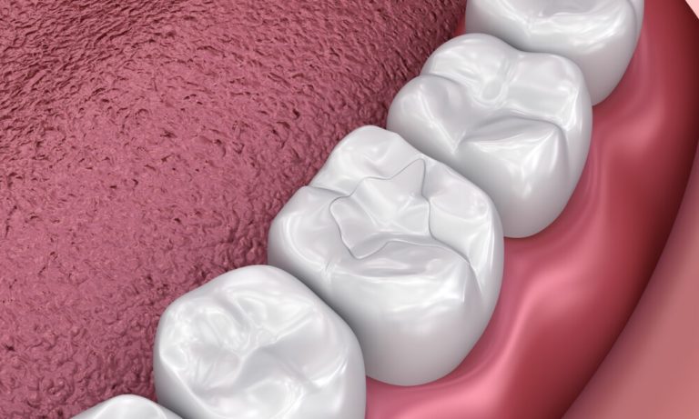 White Fillings in Surrey, BC | White Fillings Near You